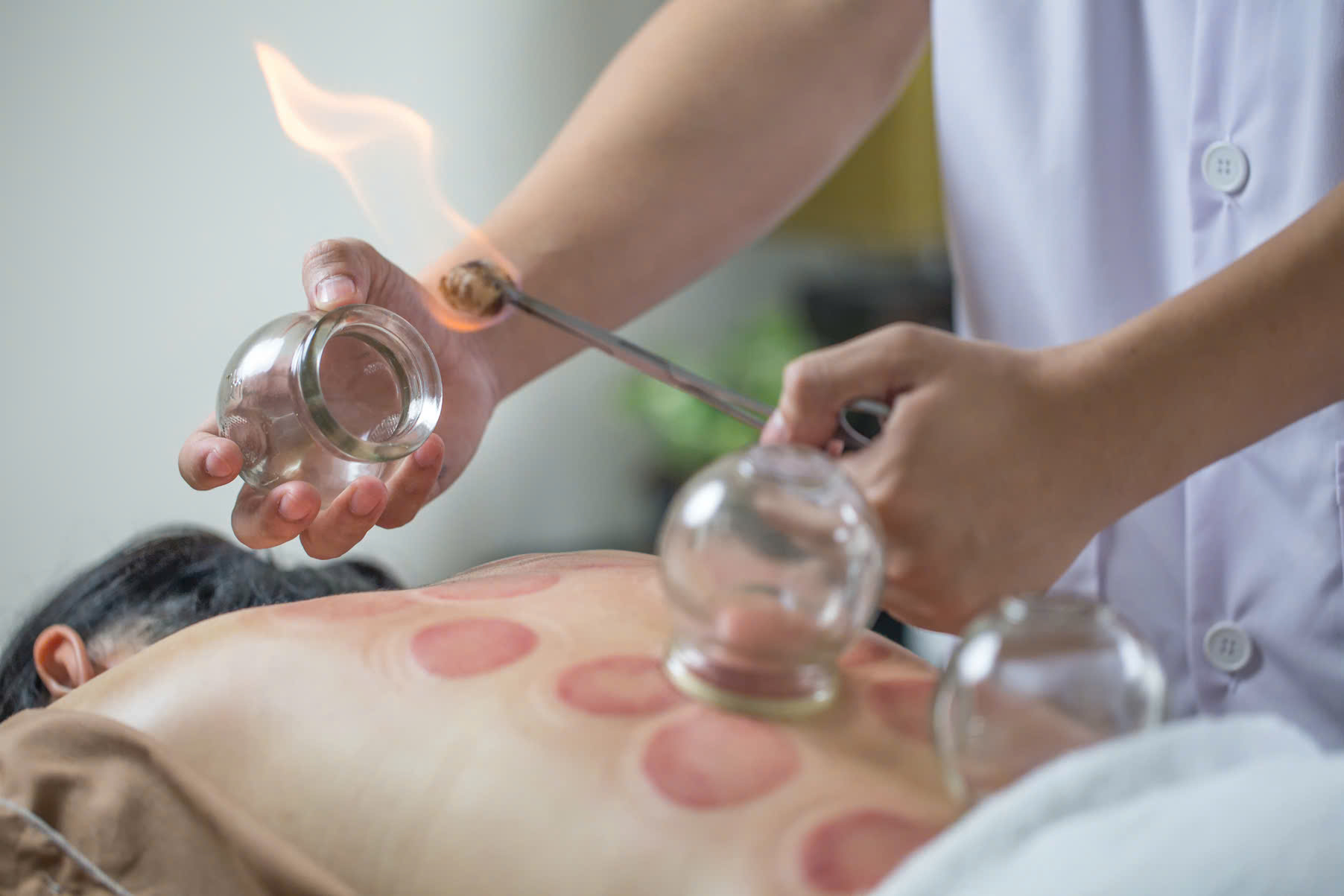 top 6 Reasons to Try Cupping Therapy Massage Today